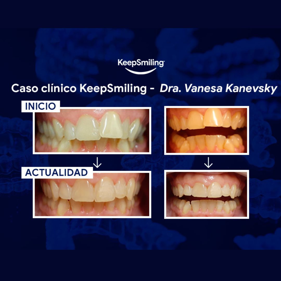 Caso clínico: Attachments y Stripping - Dra. Vanesa Kanevsky - Keepsmiling