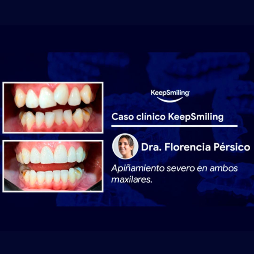Apiñamiento severo en ambos maxilares – Dra. Florencia Pérsico - Keepsmiling